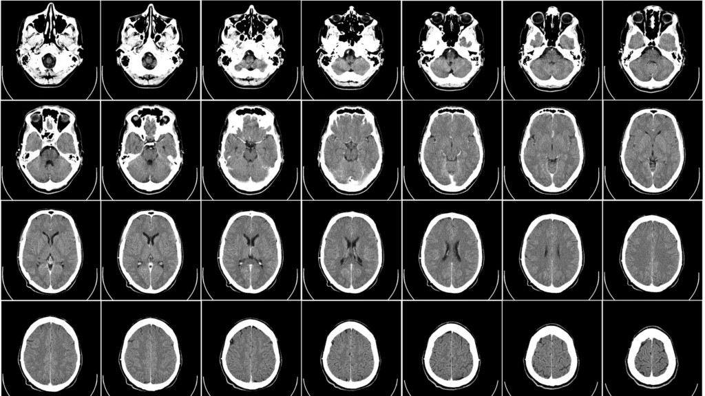 Canadian Head CT Rule - EB Medicine