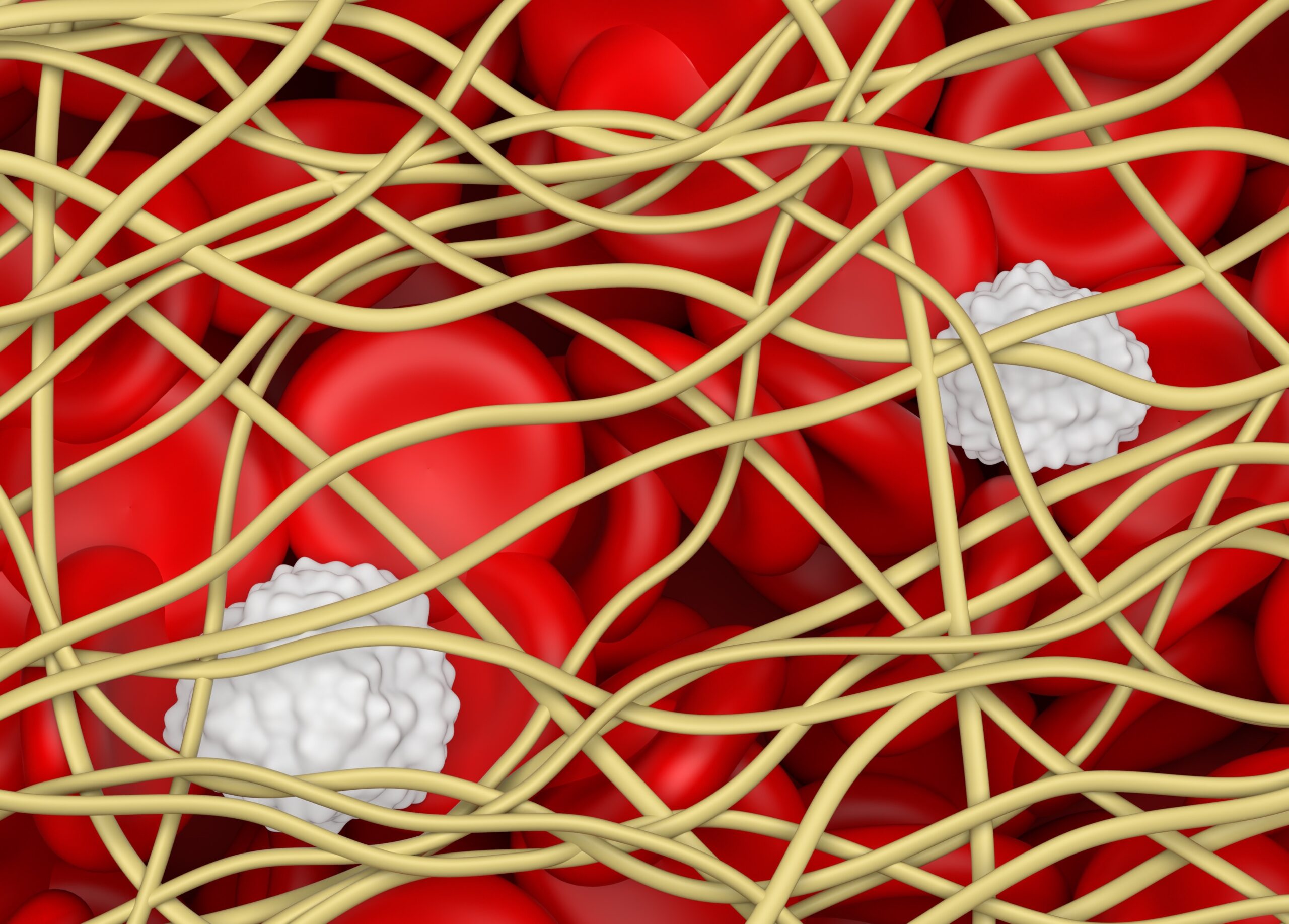 Pulmonary Embolism with Al Sacchetti, MD - EB Medicine