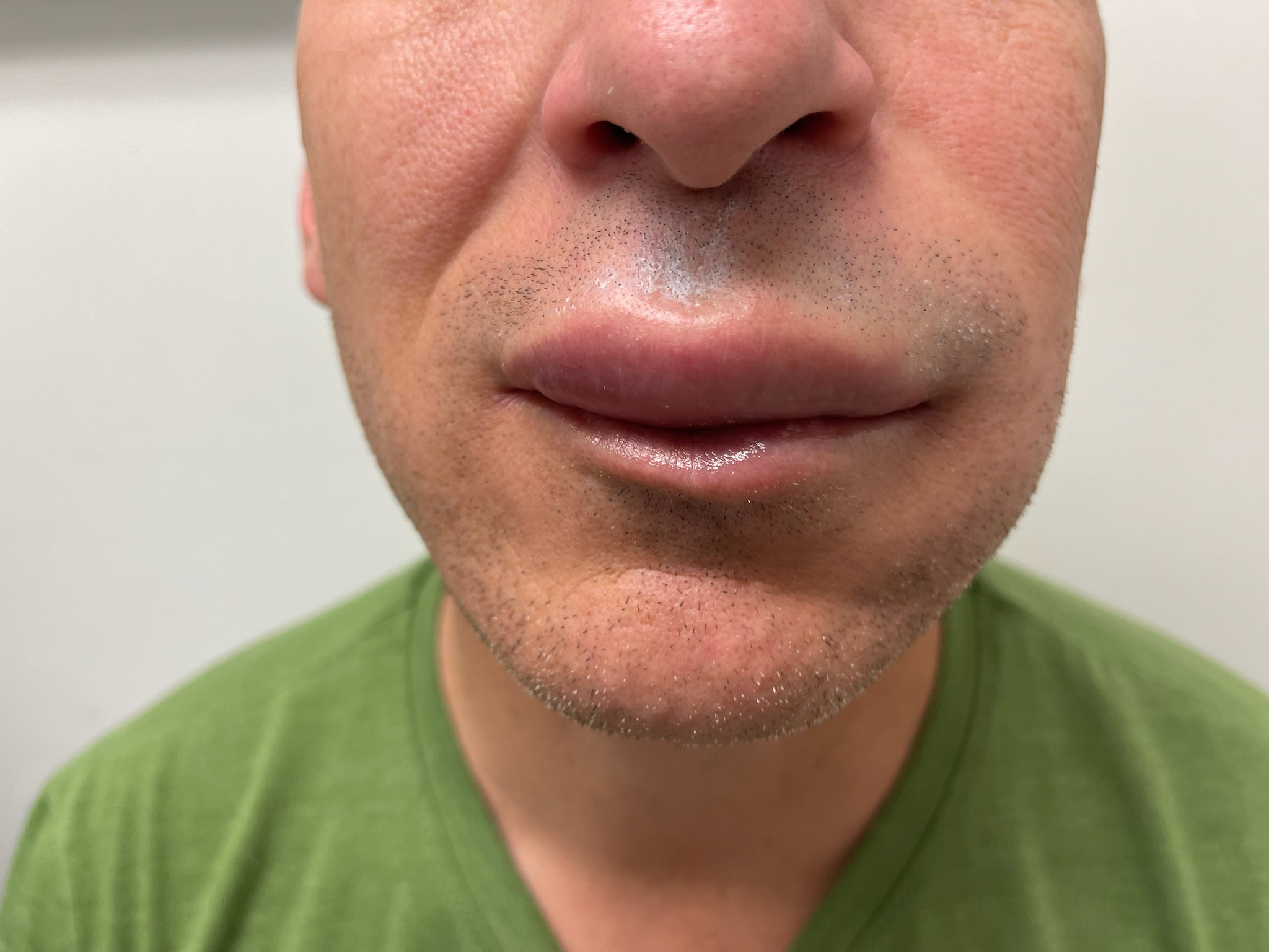 Angioedema - EB Medicine