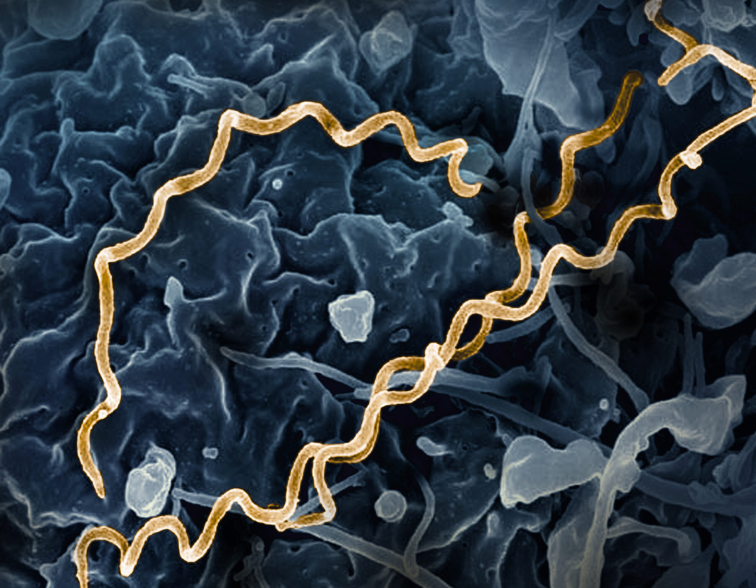 Syphilis: The Great Masquerader - EB Medicine